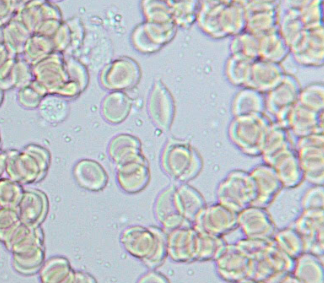Protein Dysregulation, Rouleau, RBC Aggregation M4L2 - Living Ground ...